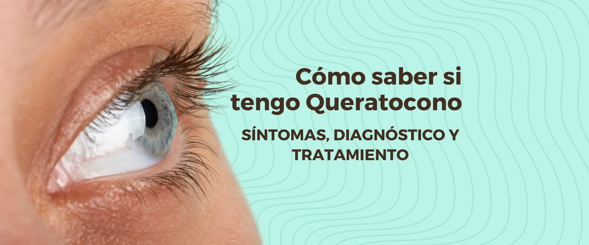 Cómo Saber si Tengo Queratocono: síntomas, diagnóstico y tratamiento ...